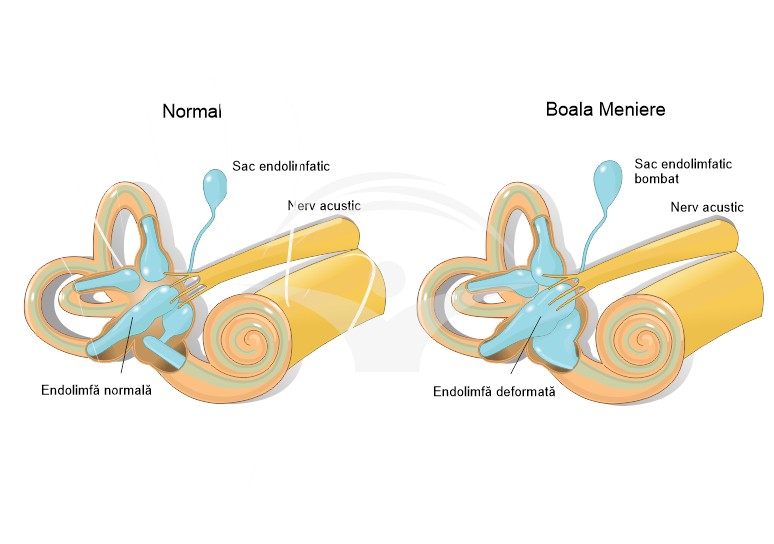 Boala Meniere: cauze, diagnostic si tratament