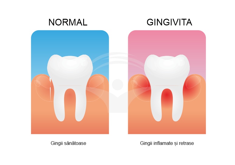 Gingivita: cauze, simptome, diagnostic si tratament