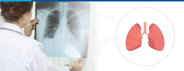 Pneumonia interstitiala: cauze, simptome, tratament